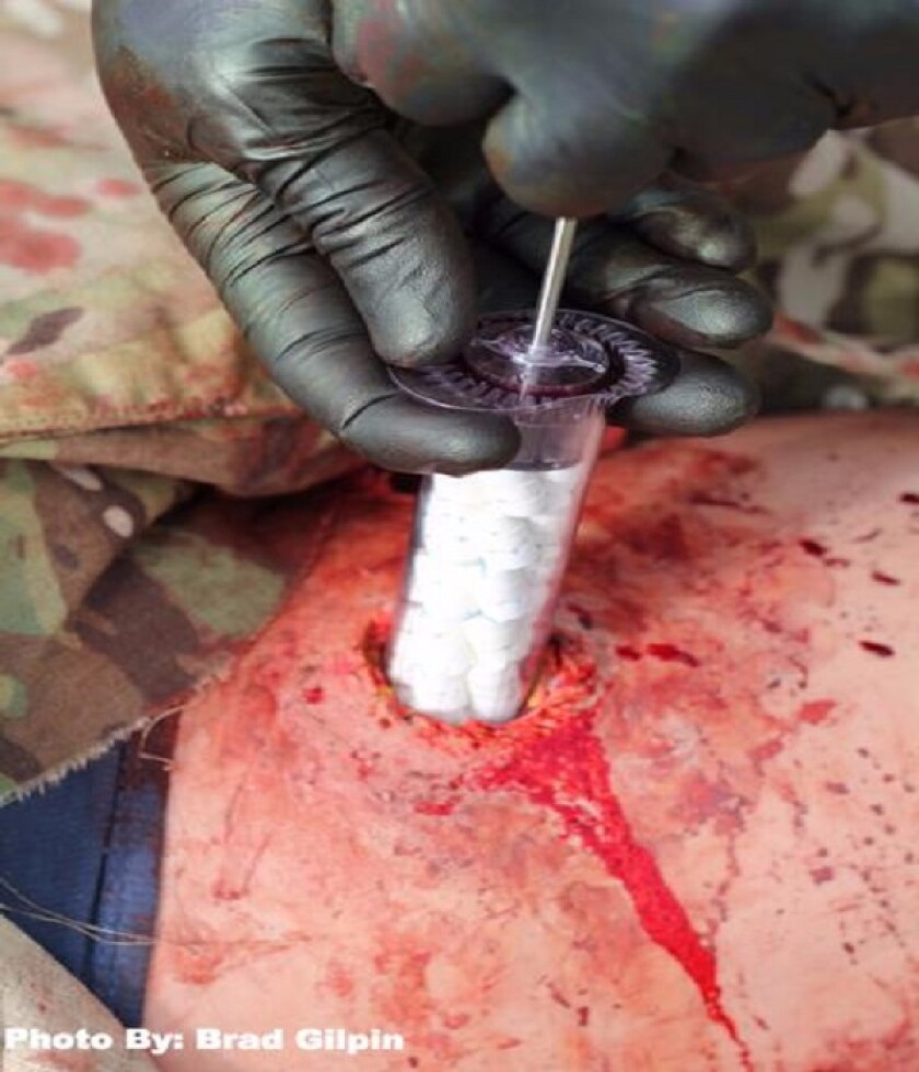 do you remove bullets from wounds